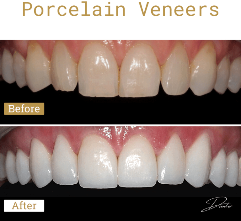 Costs of Veneers | Gold Coast Dentist | ArtSmiles - ArtSmiles General & Cosmetic Dentistry